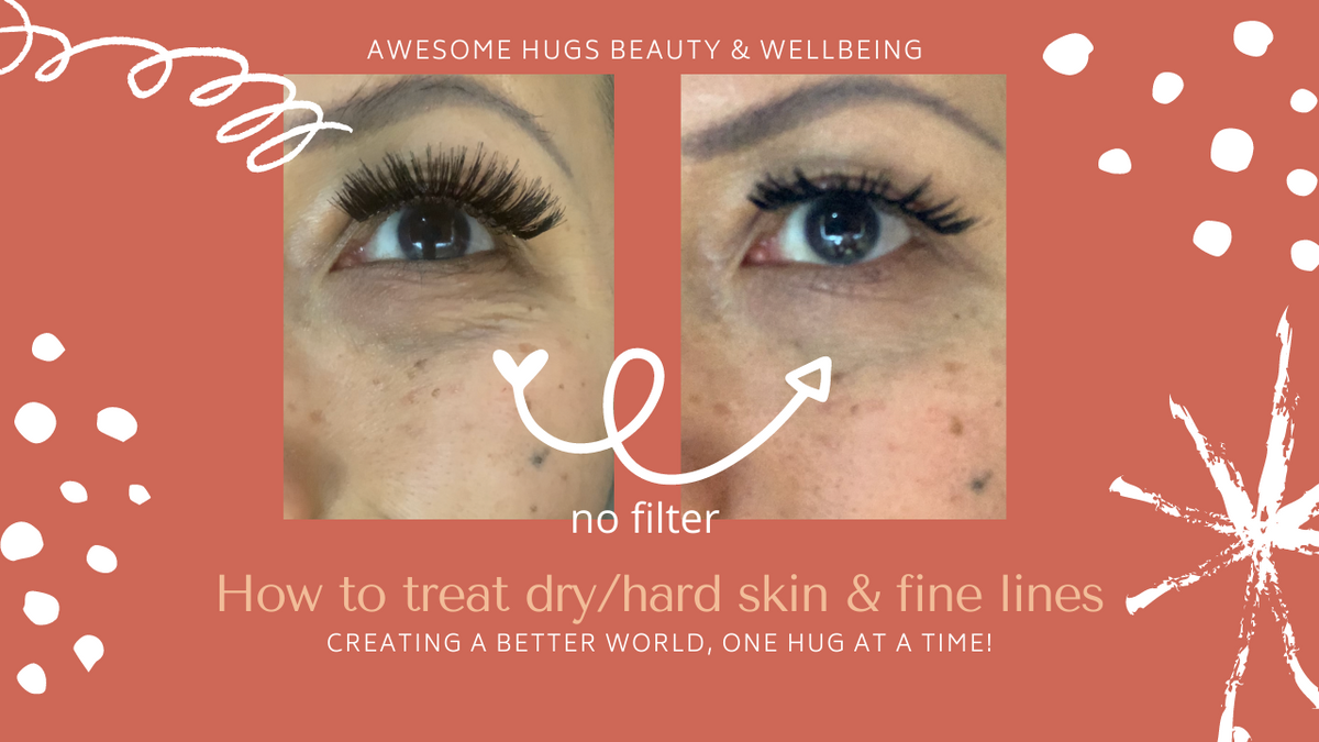 How to treat those dry/hard skin & fine lines – Awesome Hugs Beauty ...